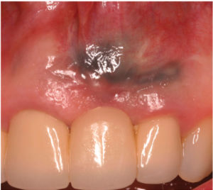 What Is an Amalgam Tattoo? Causes, Symptoms, and Treatment Options ...